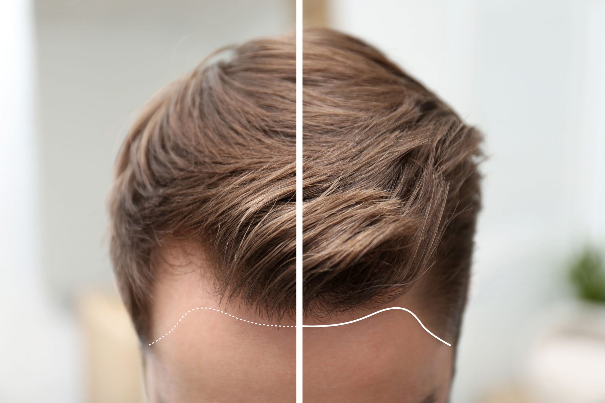 Hair Restoration Solutions at K2 Restorative Medicine