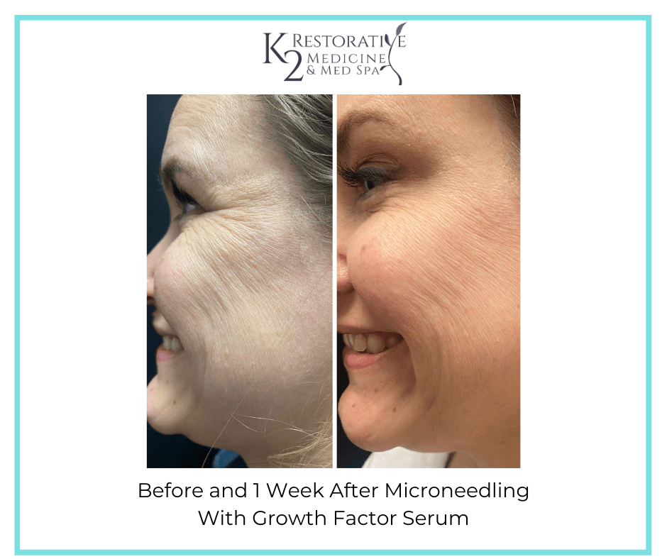 Botox & Dysport in Alabama and Florida | K2 Restorative Medicine