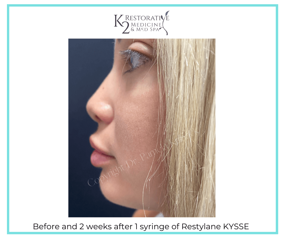 Look Young with Fillers & Injectables | Restylane & Juvederm