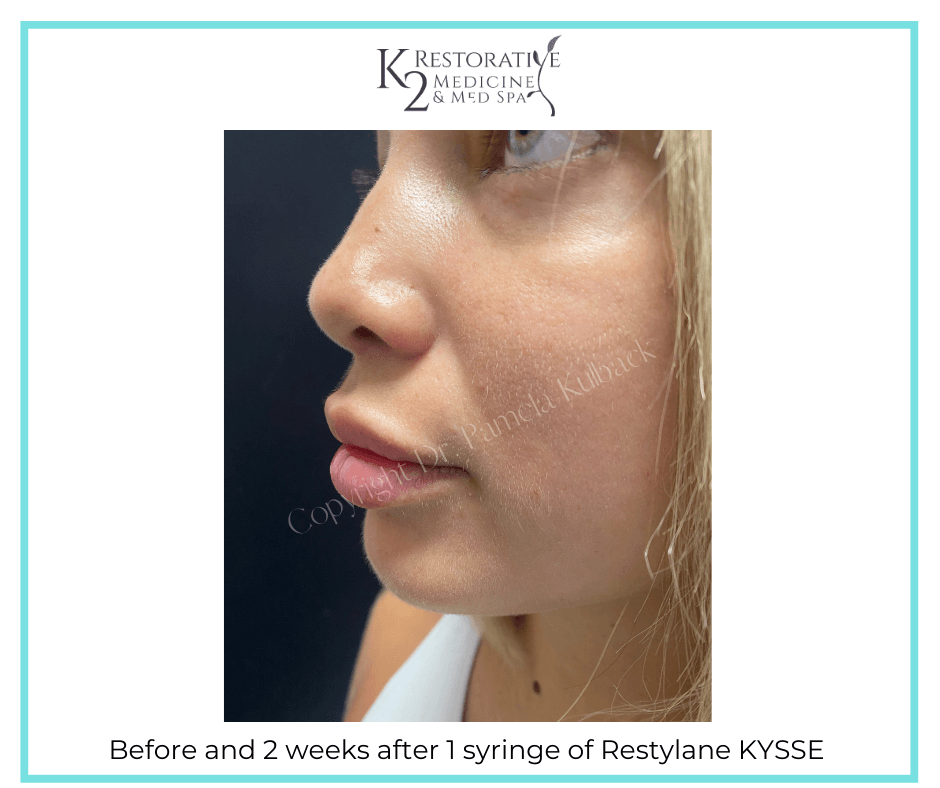 Look Young with Fillers & Injectables | Restylane & Juvederm