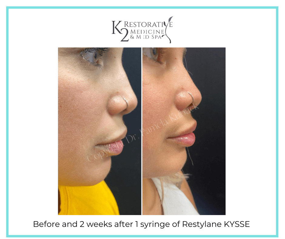 Look Young with Fillers & Injectables | Restylane & Juvederm