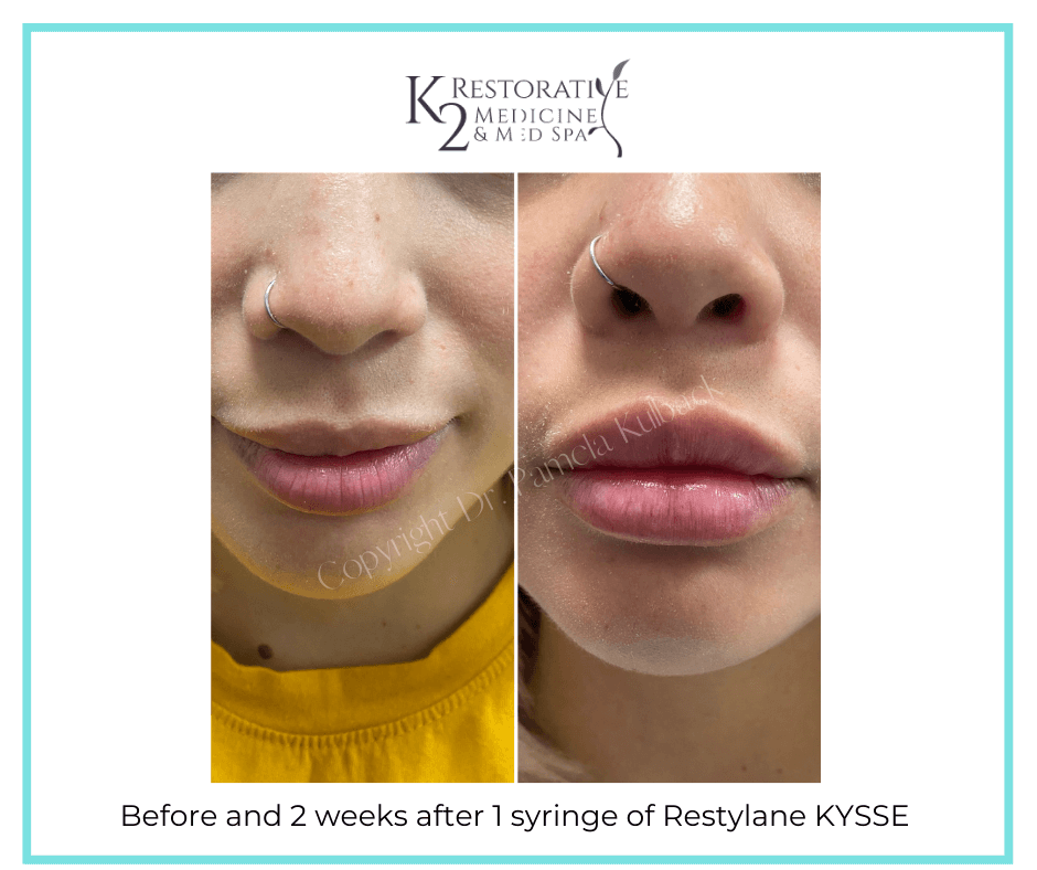 Look Young with Fillers & Injectables | Restylane & Juvederm