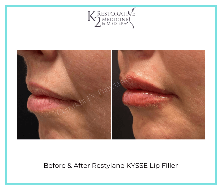 Look Young with Fillers & Injectables | Restylane & Juvederm
