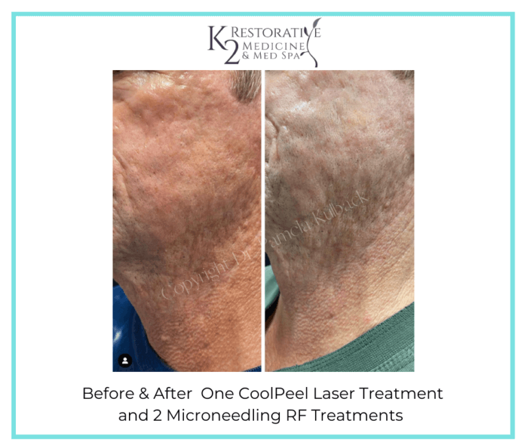 Tetra CO2 Laser & CoolPeel™ the latest in Laser Skin Resurfacing