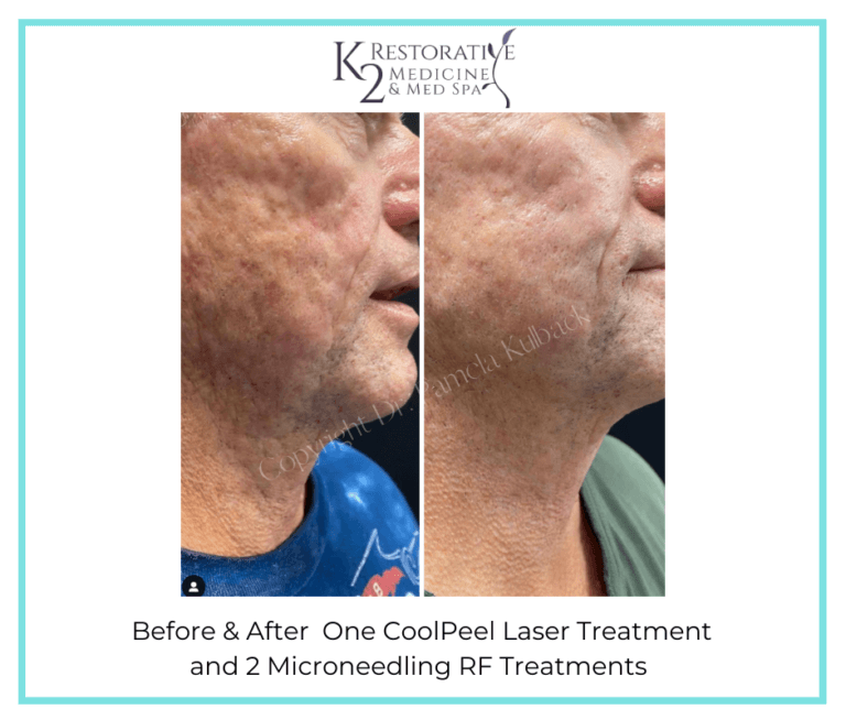 Tetra CO2 Laser & CoolPeel™ the latest in Laser Skin Resurfacing