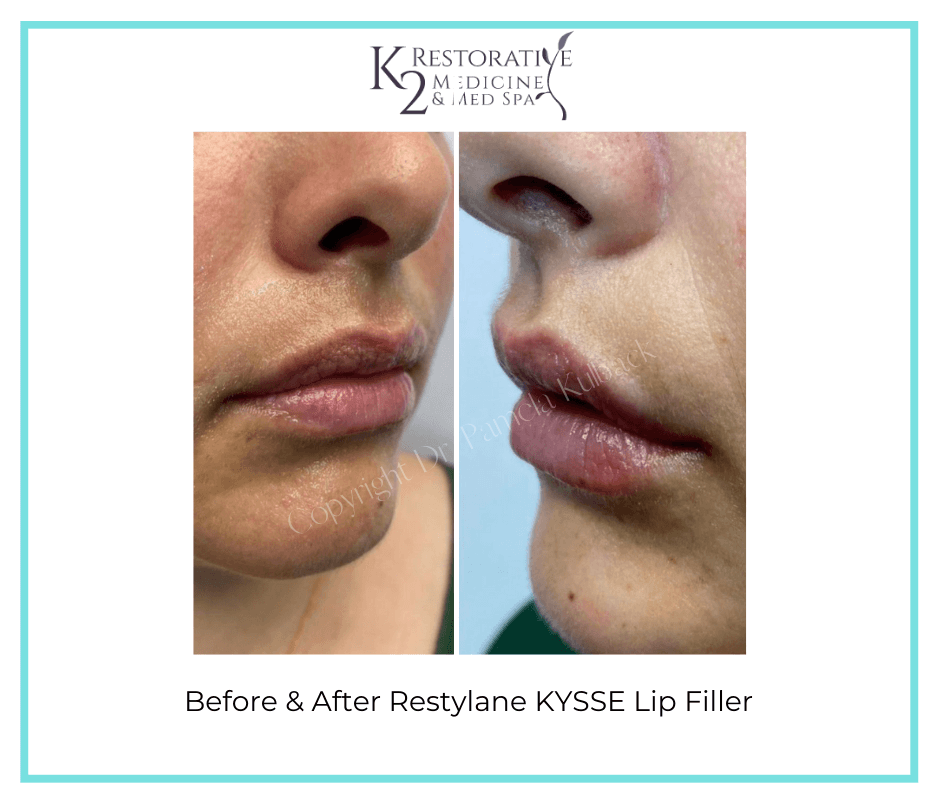 Look Young with Fillers & Injectables | Restylane & Juvederm