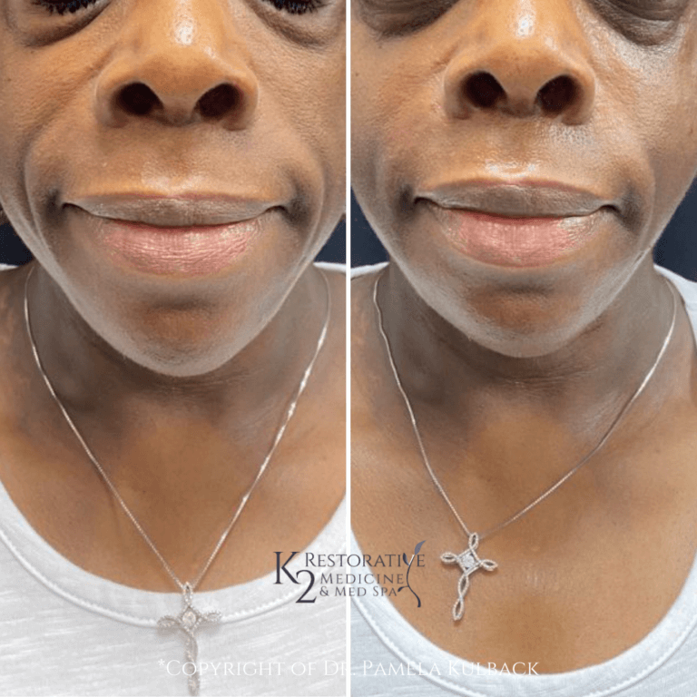 Vampire Facelift® | K2 Restorative Medicine