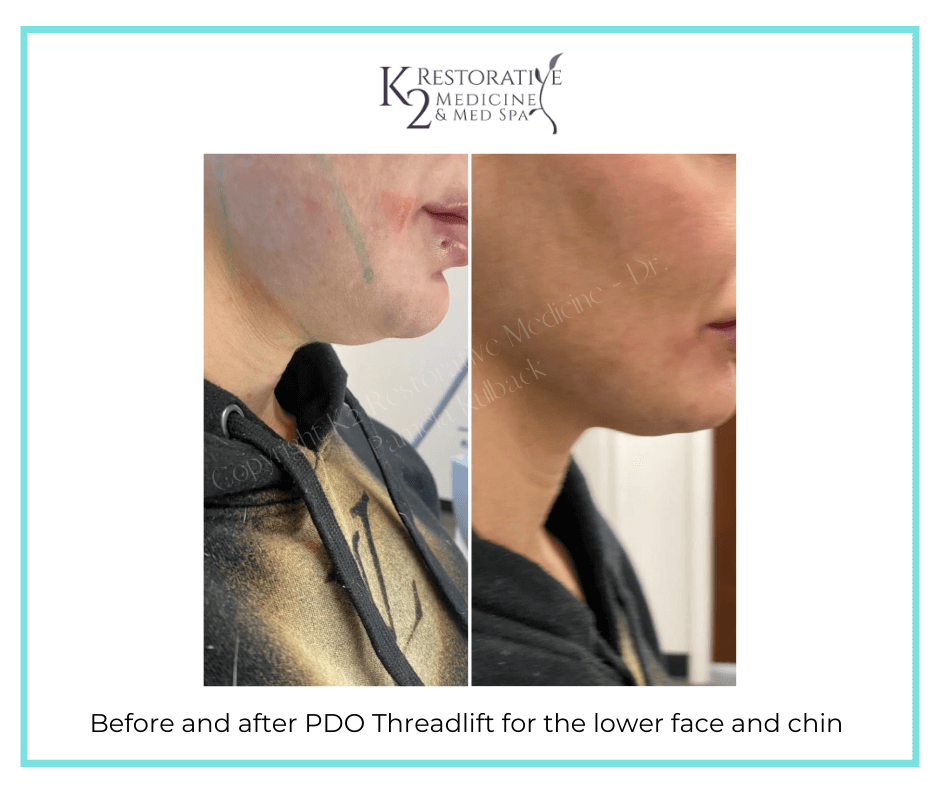 PDO thread lift in Alabama and Florida | K2 Restorative Medicine