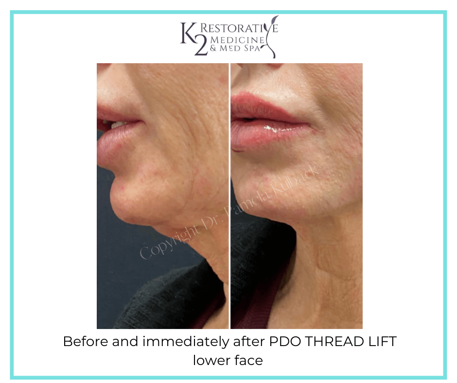 PDO thread lift in Alabama and Florida | K2 Restorative Medicine