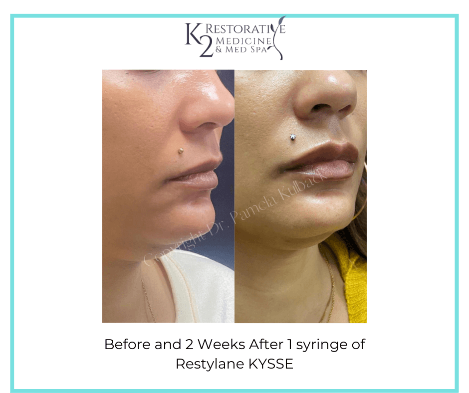 Look Young with Fillers & Injectables | Restylane & Juvederm