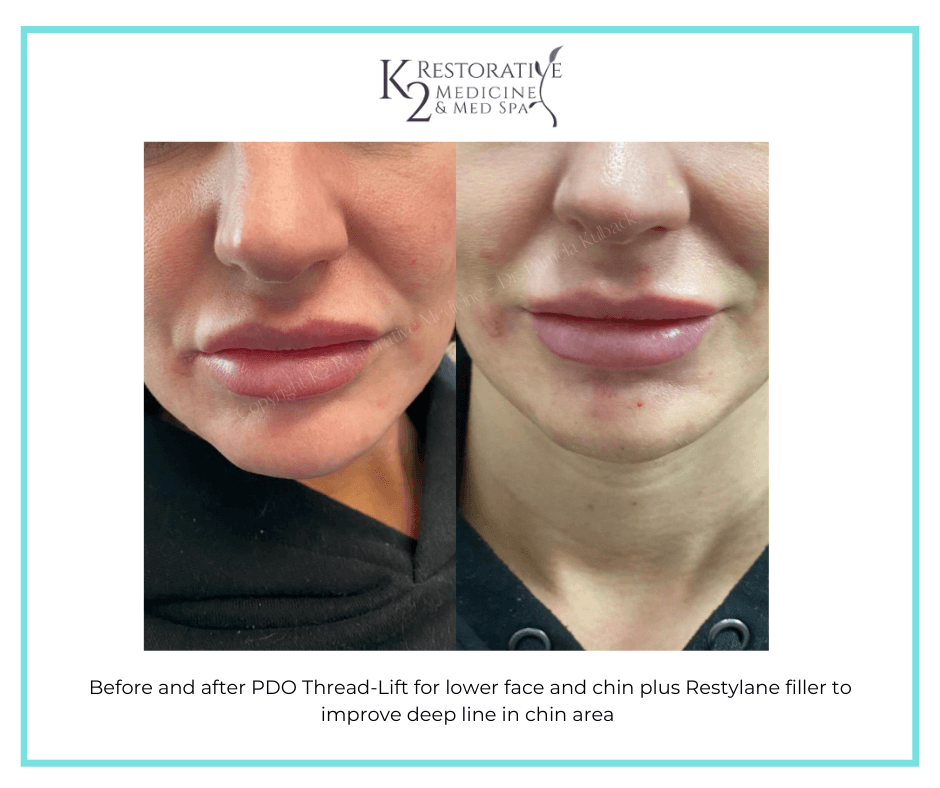 PDO thread lift in Alabama and Florida | K2 Restorative Medicine