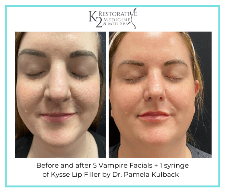 Microneedling with SkinPen | #1 FDA Approved | Birmingham, AL