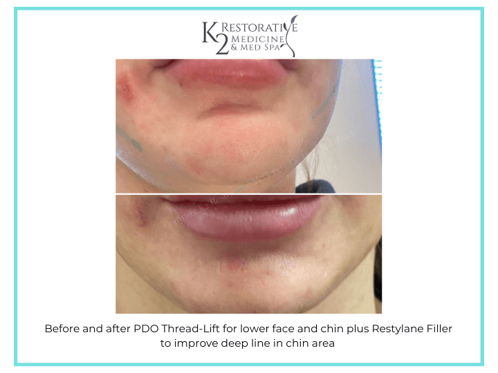 PDO thread lift in Alabama and Florida | K2 Restorative Medicine