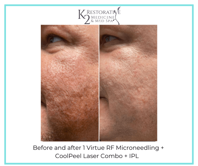 Tetra CO2 Laser & CoolPeel™ the latest in Laser Skin Resurfacing