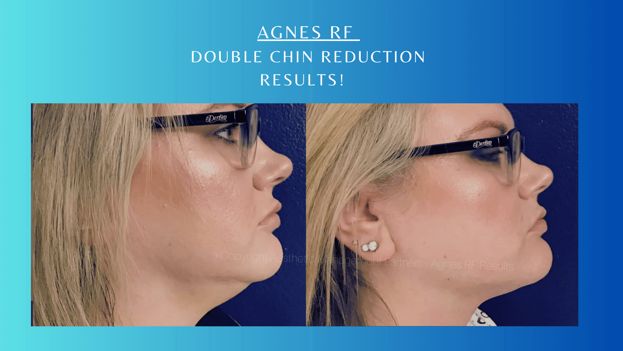 Agnes RF Microneedling | K2 Restorative Medicine in Trussville, Al