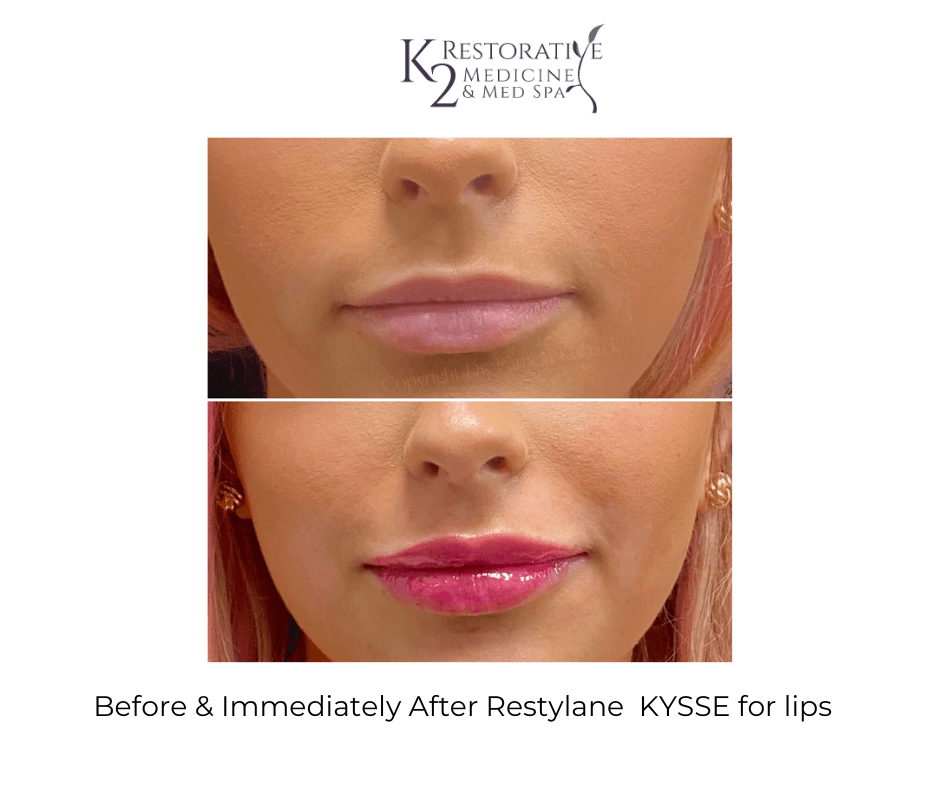Before & After Fillers & Injectables at K2 Restorative Medicine