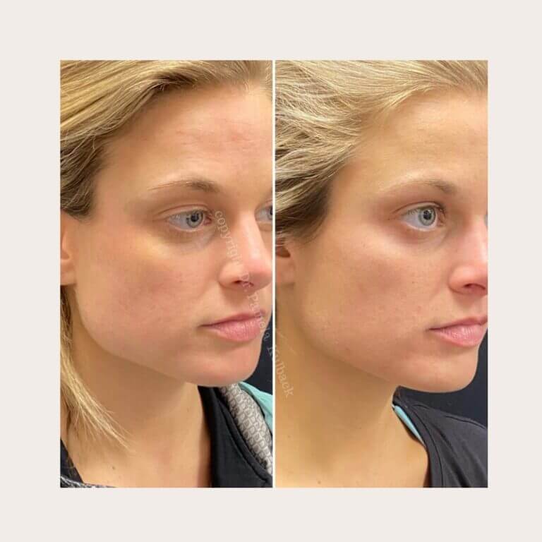 Botox & Dysport in Alabama and Florida | K2 Restorative Medicine