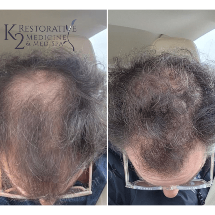 Hair Restoration at K2 Restorative Medicine| Trussville, AL